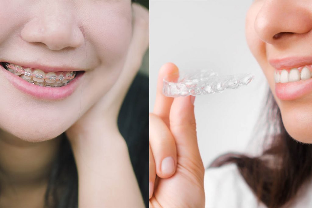 Aligners vs Braces - Which is Better for You? - Pristine Dentalworks